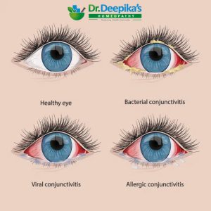 Best Homeopathic Medicine For Pink Eye Or Conjunctivitis