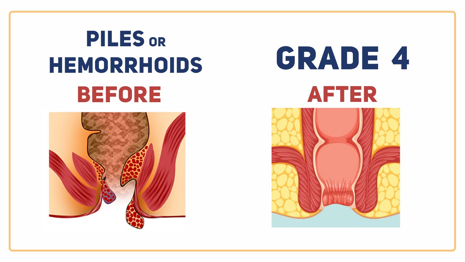 Homeopathy Medicine For Piles (Hemorrhoids) | Dr. Deepika